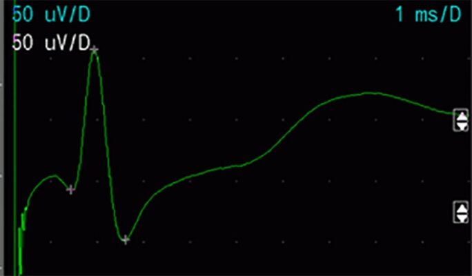 NERVE CONDUCTION STUDIES (NCS) & ELECTROMYOGRAPHY (EMG) - Neurocare