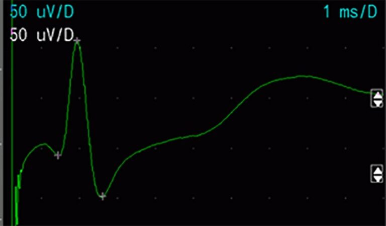 NERVE CONDUCTION STUDIES (NCS) & ELECTROMYOGRAPHY (EMG) - Neurocare